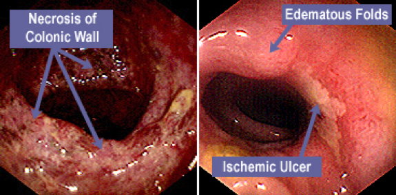 How do you approach ischemic colitis? – Inspired MedEd
