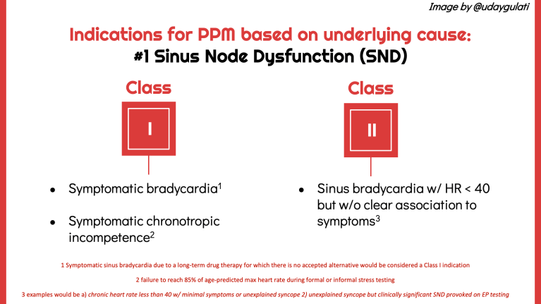 What are indications for a permanent pacemaker? – Inspired MedEd