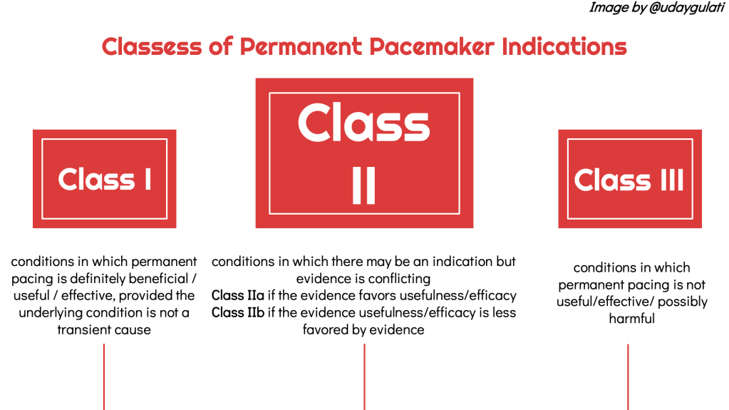 What are indications for a permanent pacemaker? – Inspired MedEd